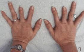 Sindactilia y malformaciones en los dedos